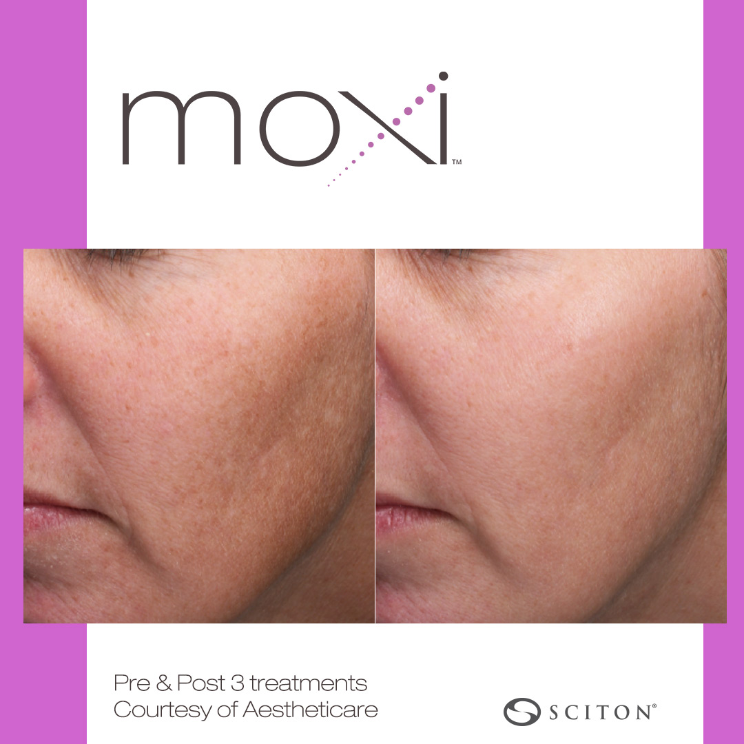 MOXI™ Laser Skin Rejuvenation Springfield, Massachusetts | Dr. Glen Brooks